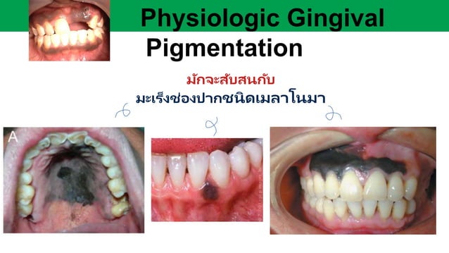 Normal variation | PPTX