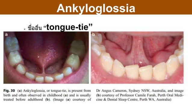 Normal variation | PPTX