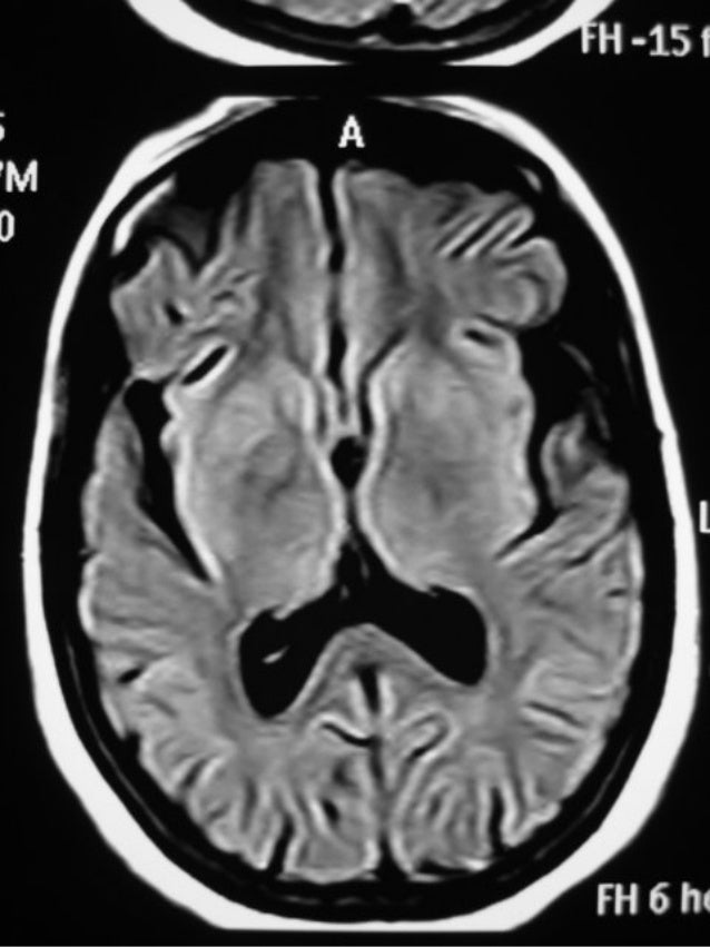 Slide show...Progressive supranuclear palsy