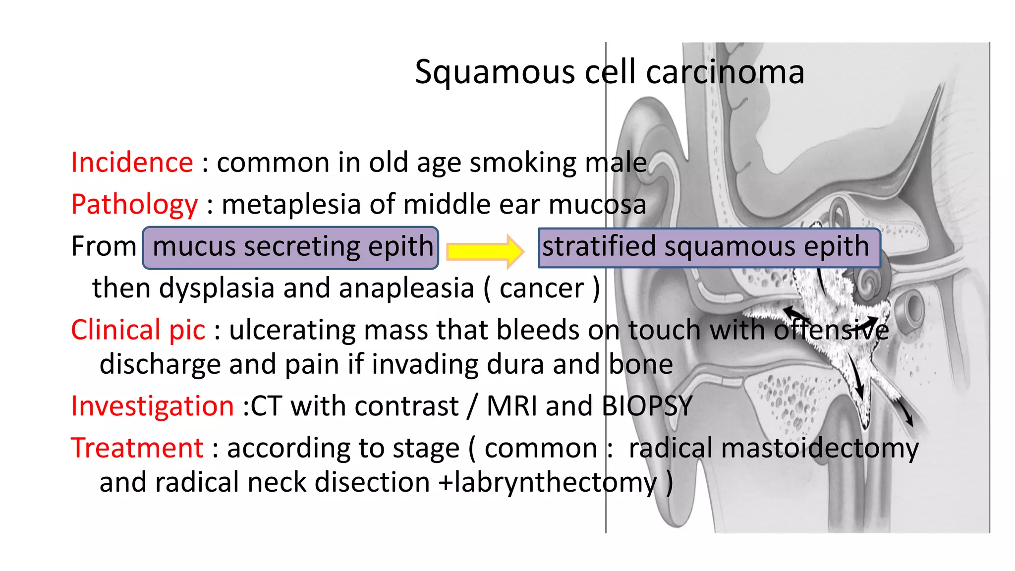 common middle ear tumors | PDF