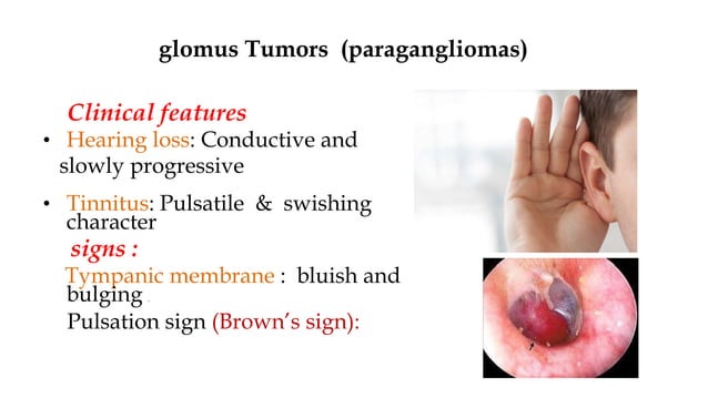 common middle ear tumors | PDF