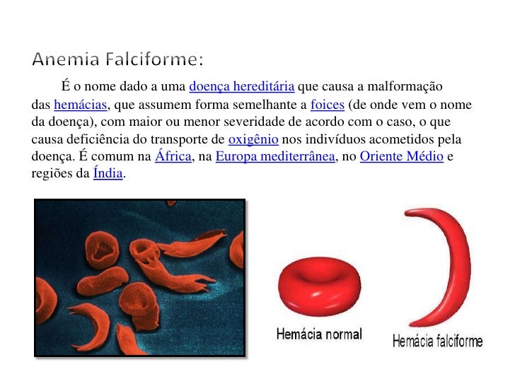 Anemia falciforme