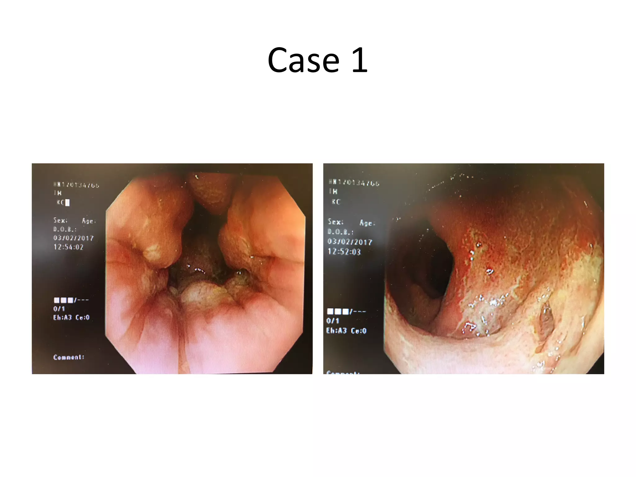 Lymphogranuloma venereum - Professor Ivan Hung | PDF