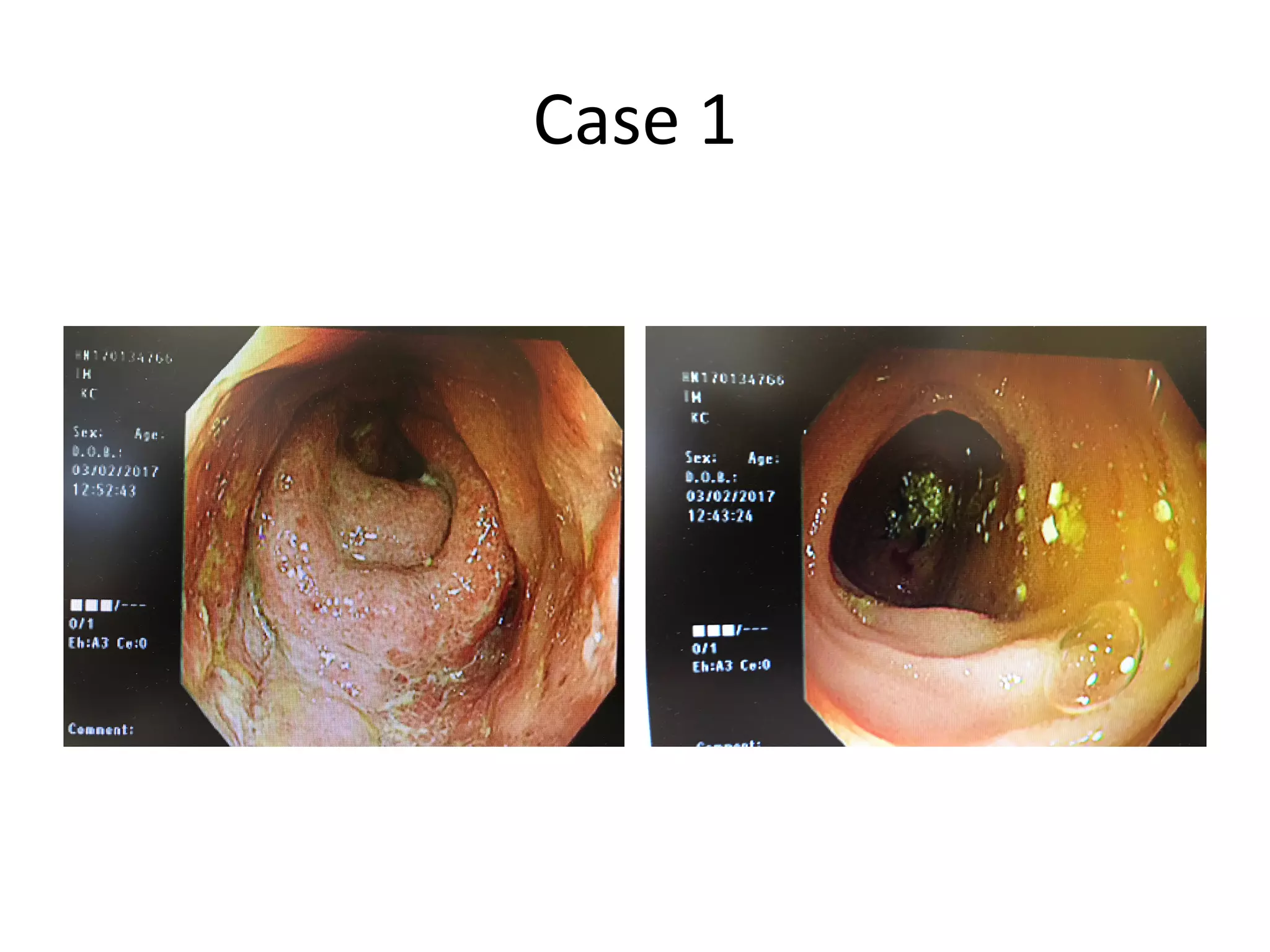 Lymphogranuloma venereum - Professor Ivan Hung | PDF