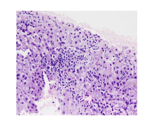 Slides for liver slide seminar,Pathology CME,Govt.Medical College ...
