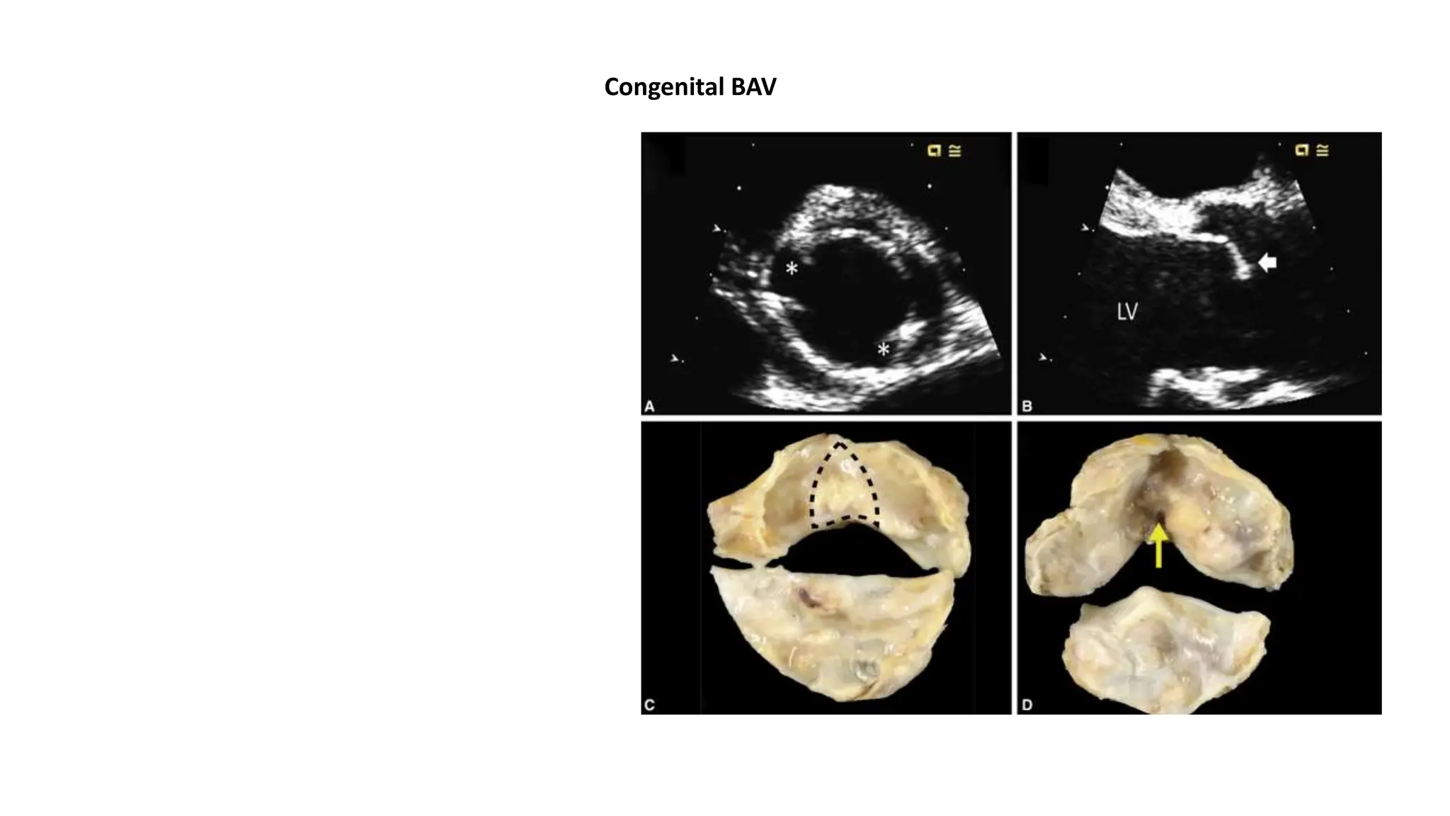 Slides For The Meeting On Bicuspid Aortic Valvepptx