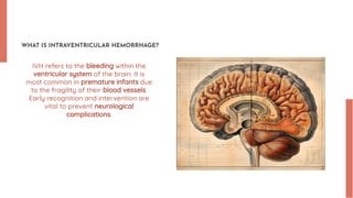 Intraventricular Hemorrhage in pediatrics | PDF