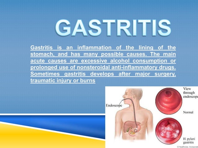 Digestion System's Diseases | PPTX