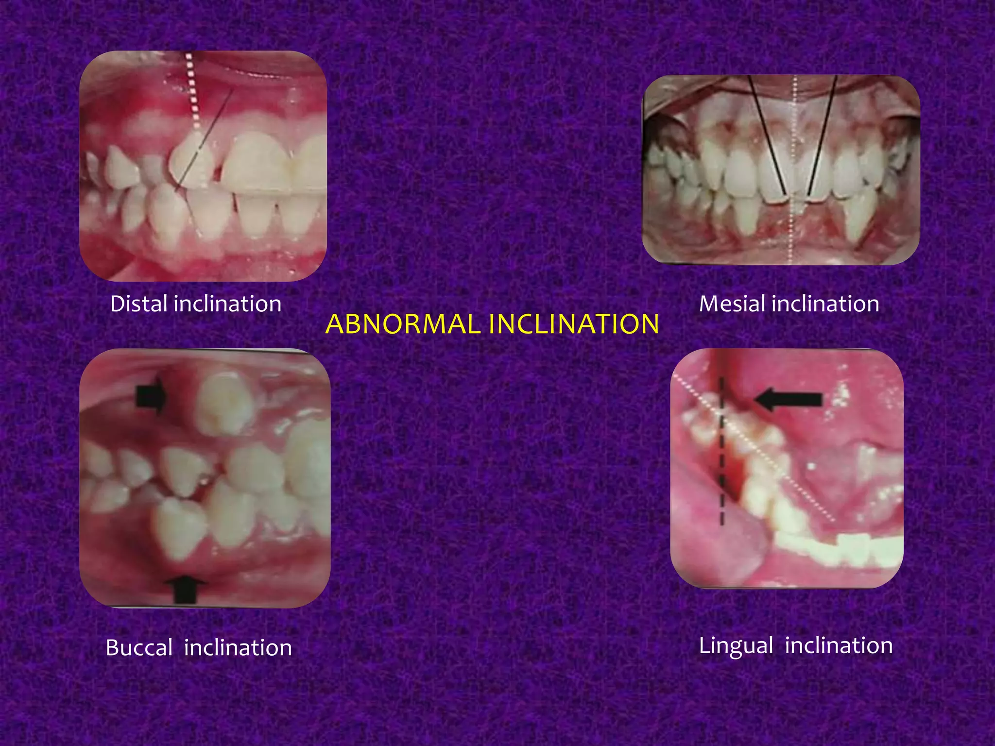 Classification of Malocclusion | PPTX