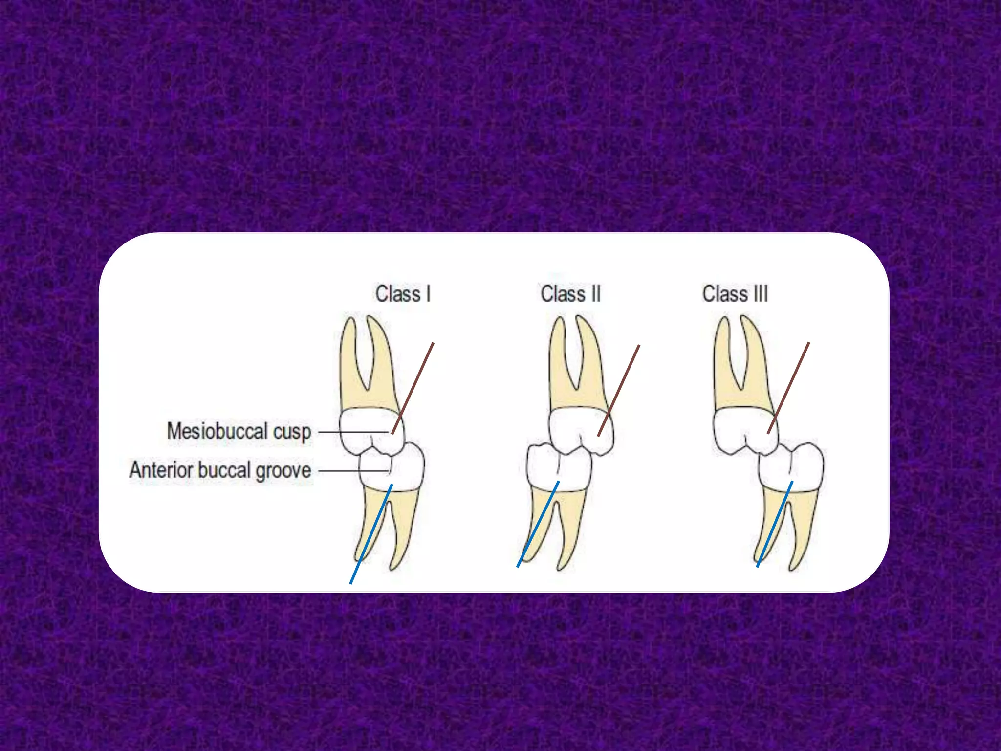 Classification of Malocclusion | PPTX