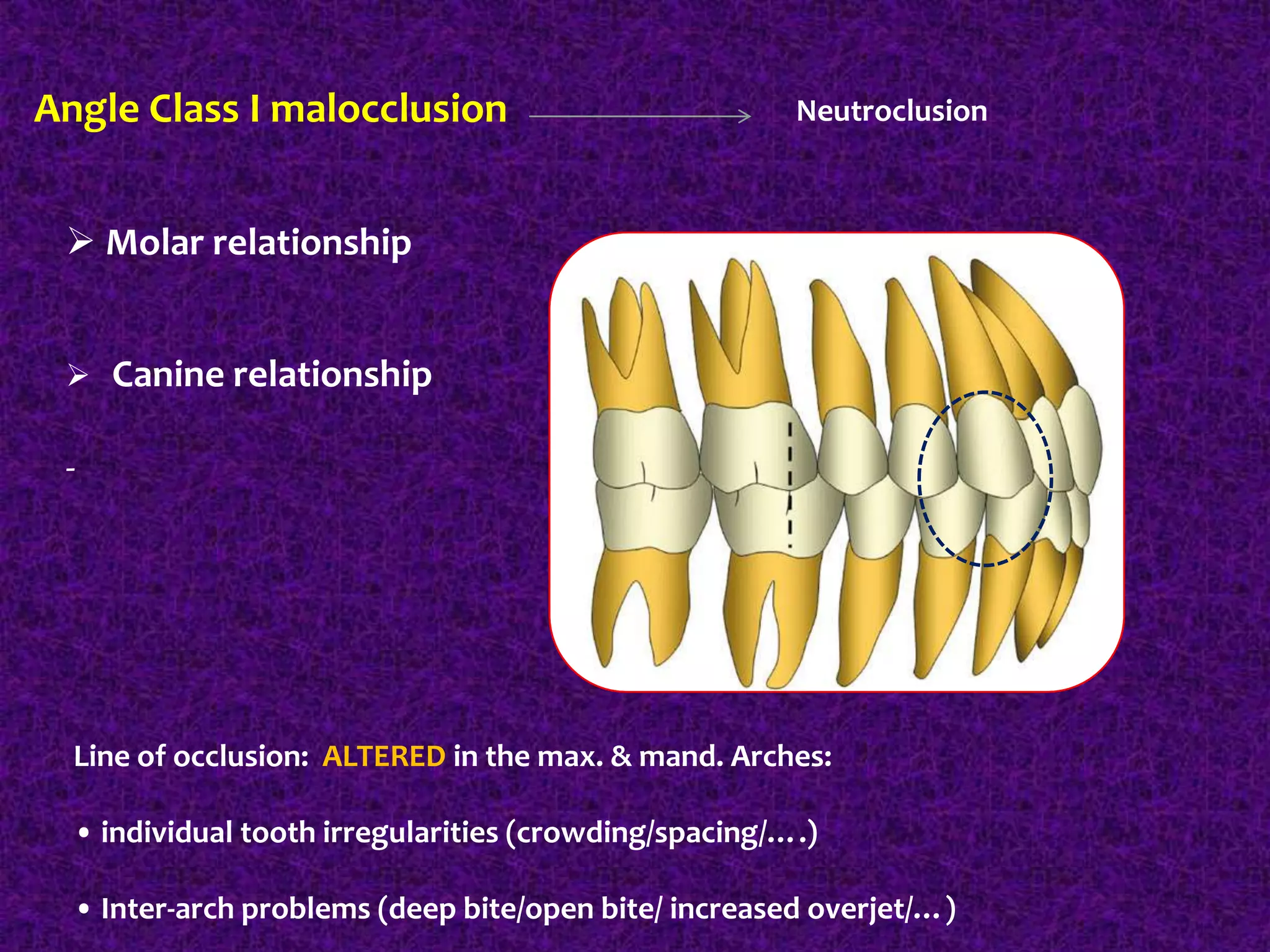 Classification of Malocclusion | PPTX