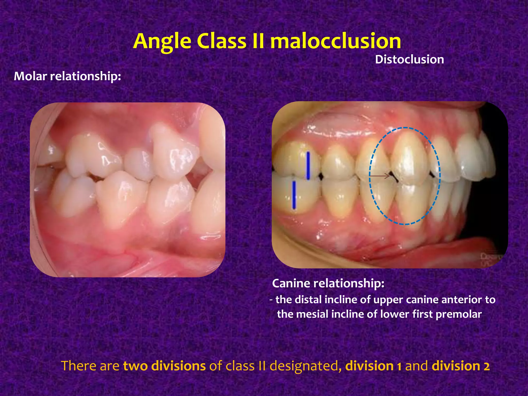 Classification of Malocclusion | PPTX