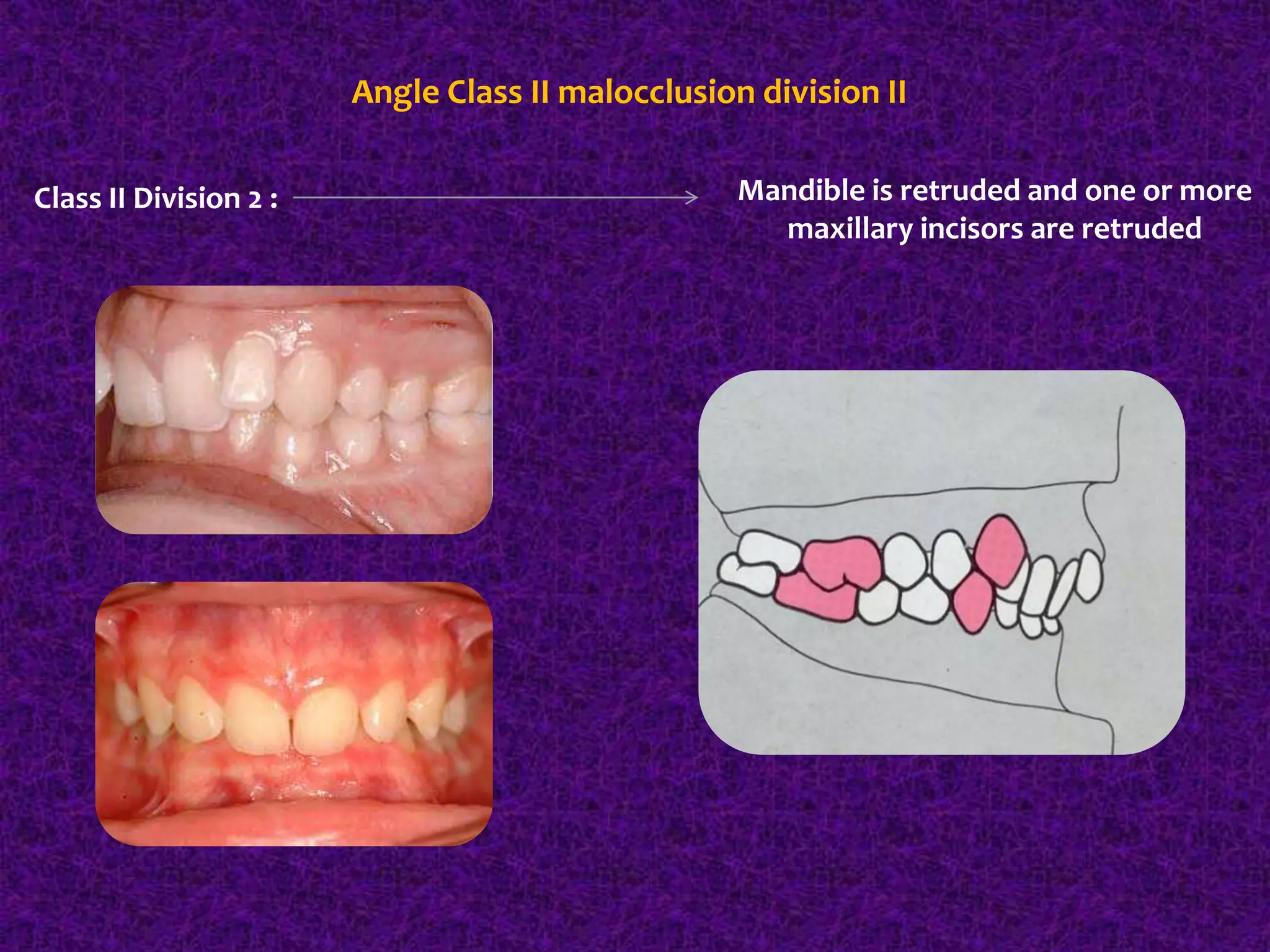 Classification of Malocclusion | PPTX