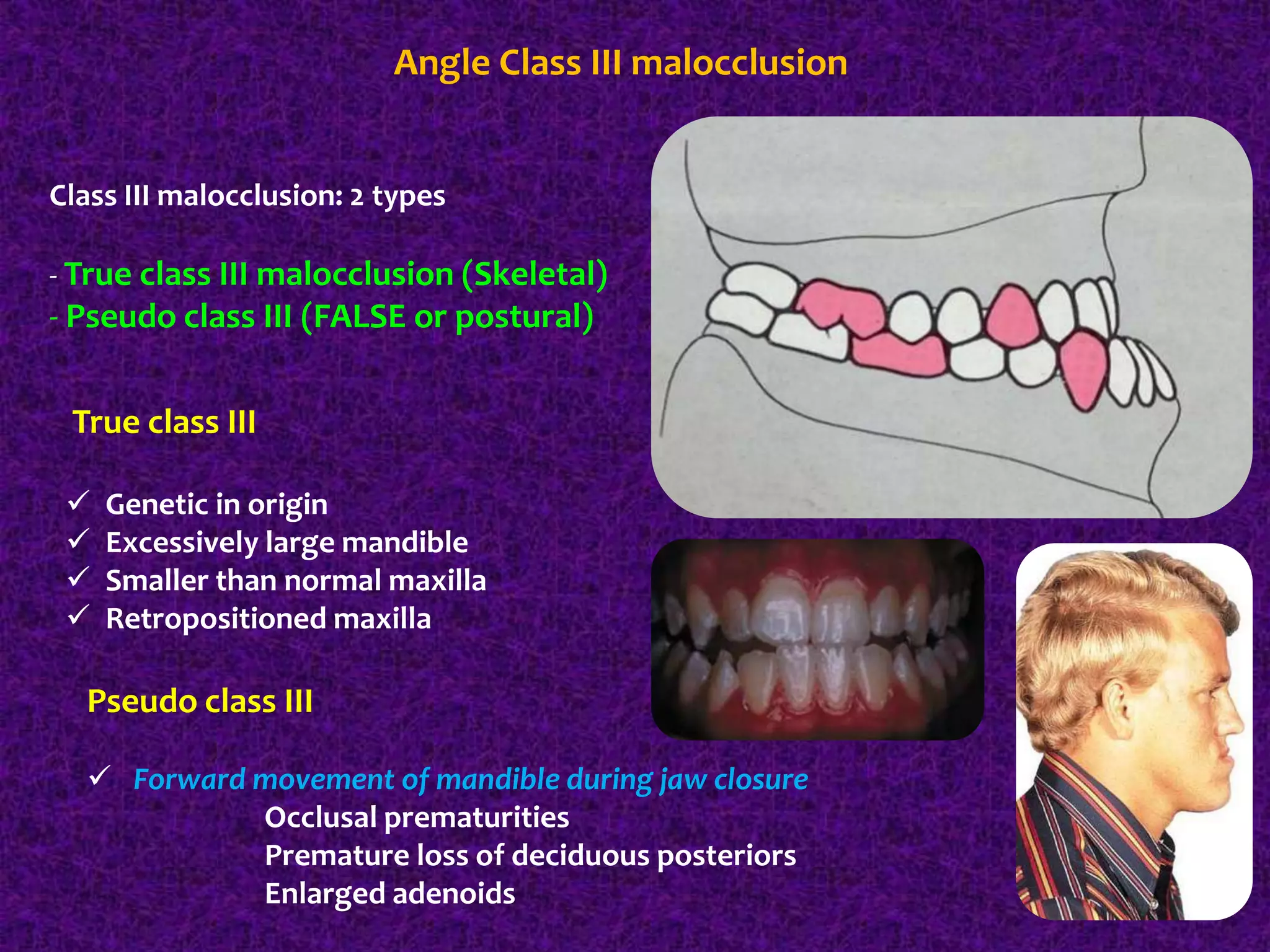 Classification of Malocclusion | PPTX