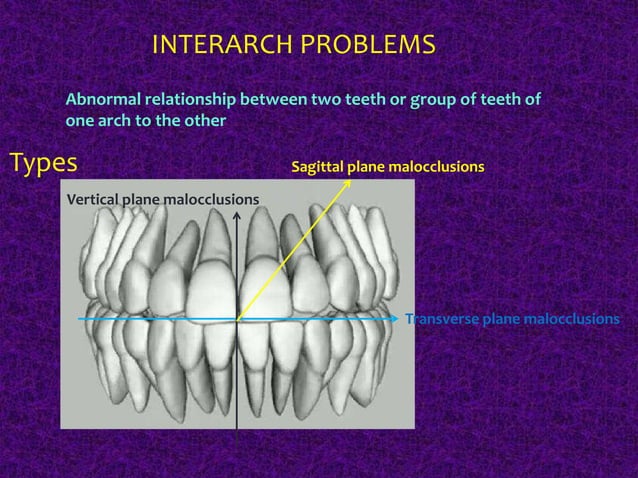Classification of Malocclusion | PPTX