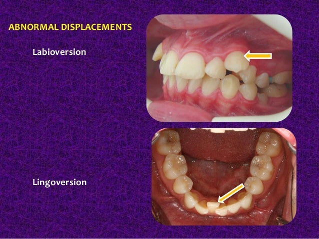classification of malocclusion