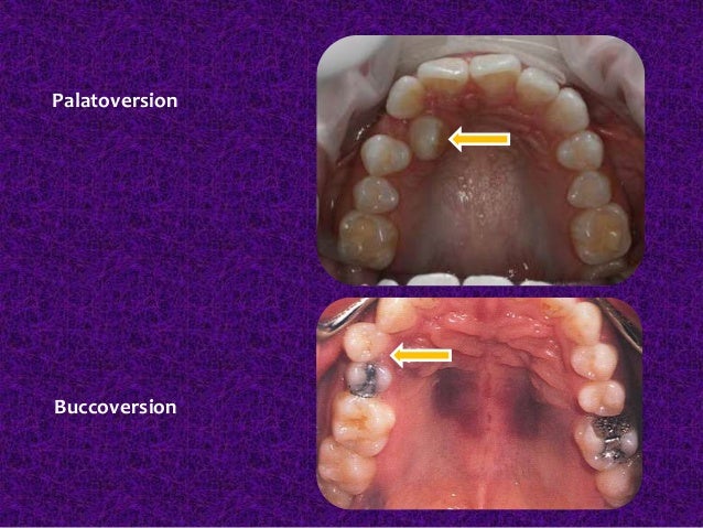 classification of malocclusion