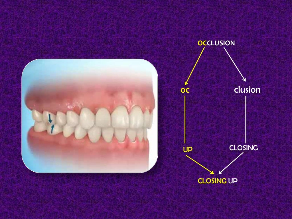 Classification of Malocclusion