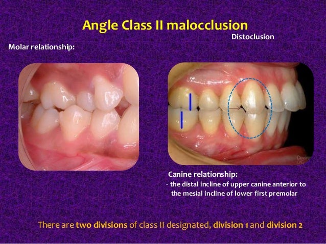 classification of malocclusion