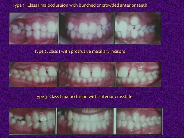 classification of malocclusion