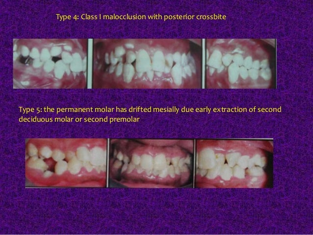 Classification of Malocclusion