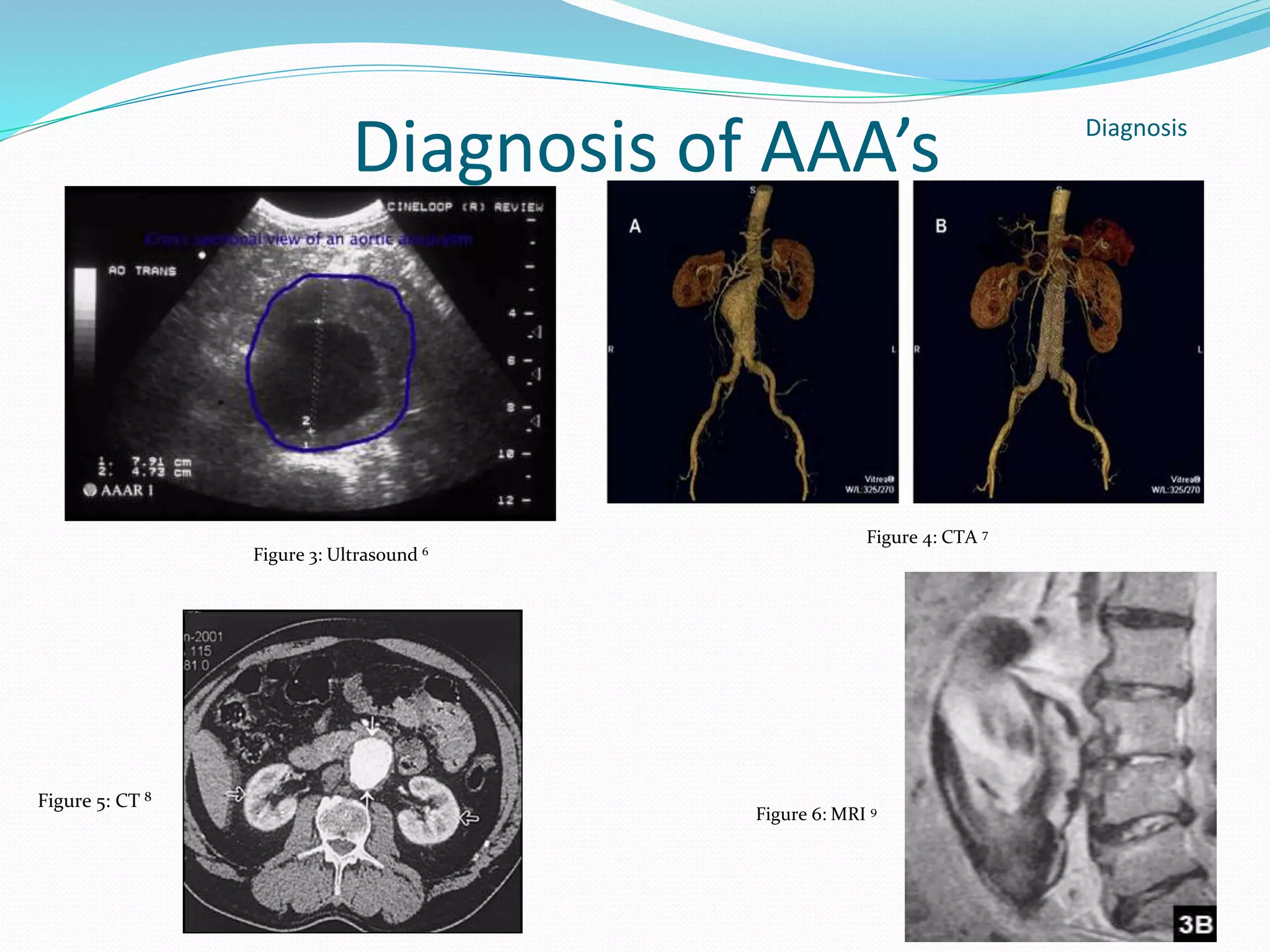 Abdominal Aortic Aneurysms. A Review | PPTX