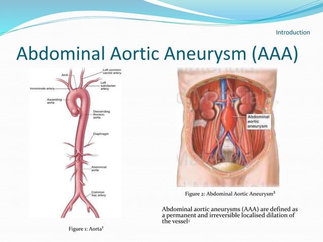 Abdominal Aortic Aneurysms. A Review | PPTX