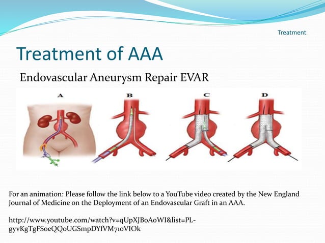 Abdominal Aortic Aneurysms. A Review | PPTX