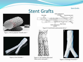 Abdominal Aortic Aneurysms. A Review | PPTX