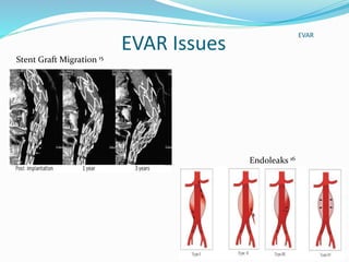 Abdominal Aortic Aneurysms. A Review | PPTX