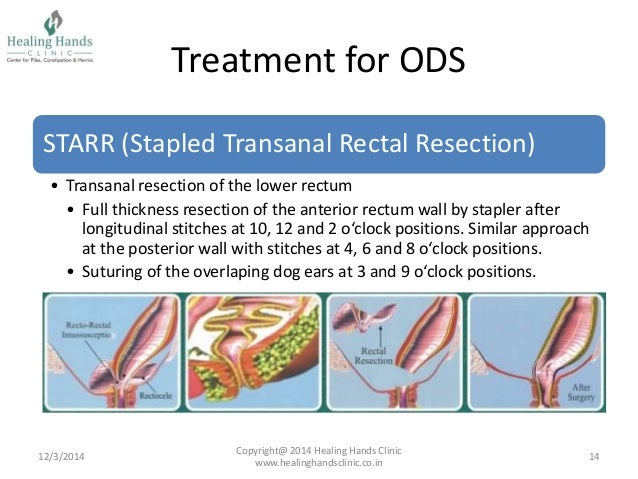 Obstructed Defecation Syndrome: Diagnosis & Surgical Treatment