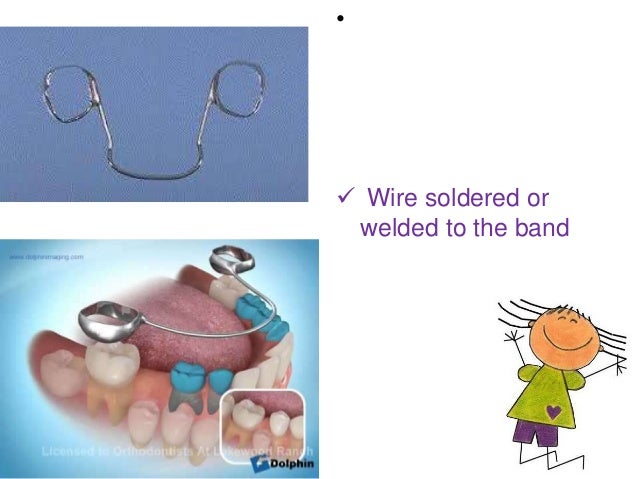 lingual holding arch space maintainer