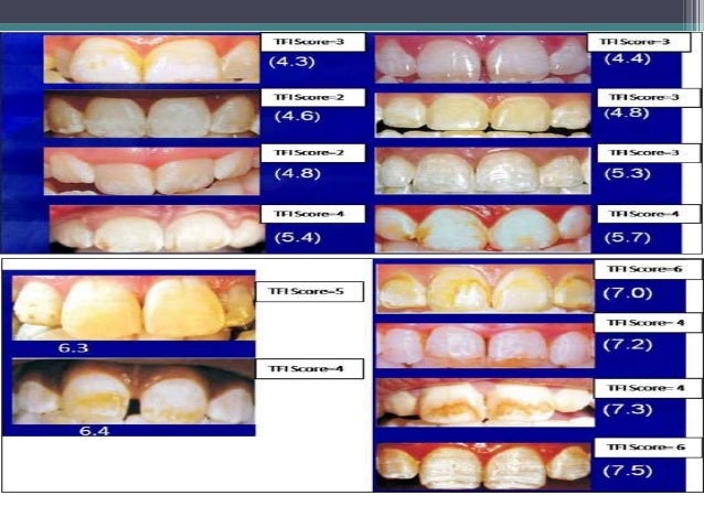 fluoride indices in dentistry