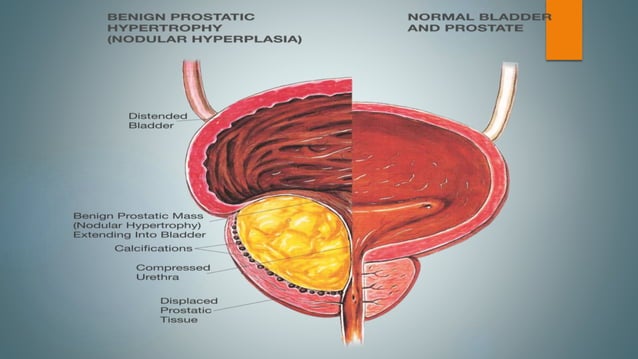 Benign Prostatic Hyperplasia | PPT