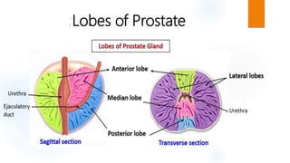 Benign Prostatic Hyperplasia | PPT