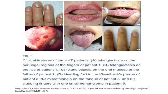 BLEEDING AND CLOTTING DISORDERS | PPTX
