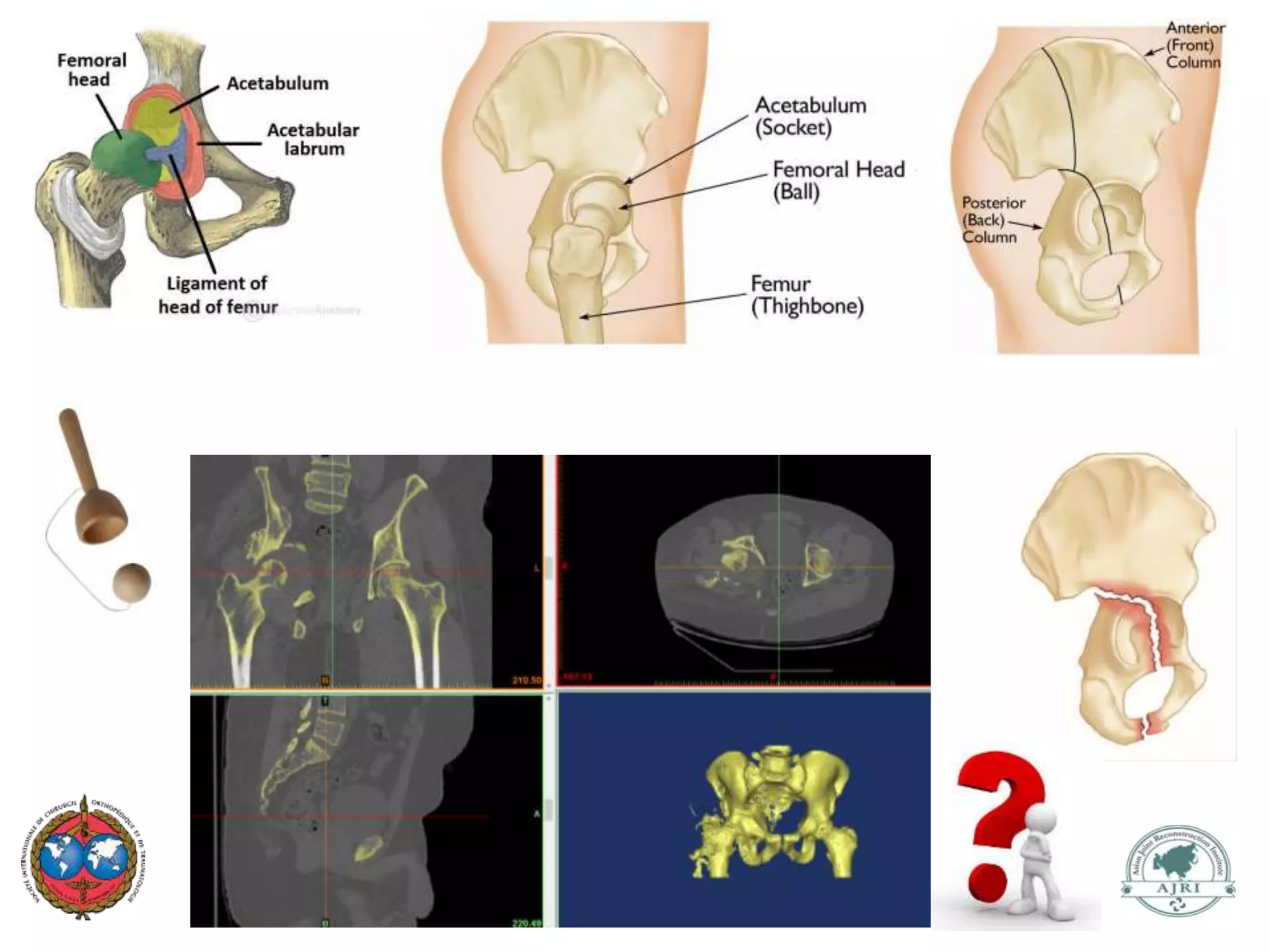 3D Printing and 3D Models as a part of Preplanning for Complex Total ...