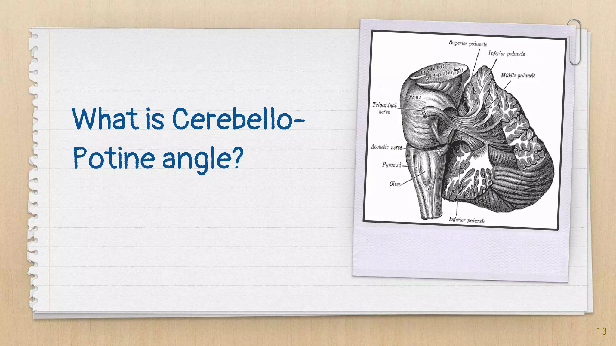 Vestibular schwannoma (acoustic neuroma) surgical anatomy and microsurgeries, cerebellopontine ...