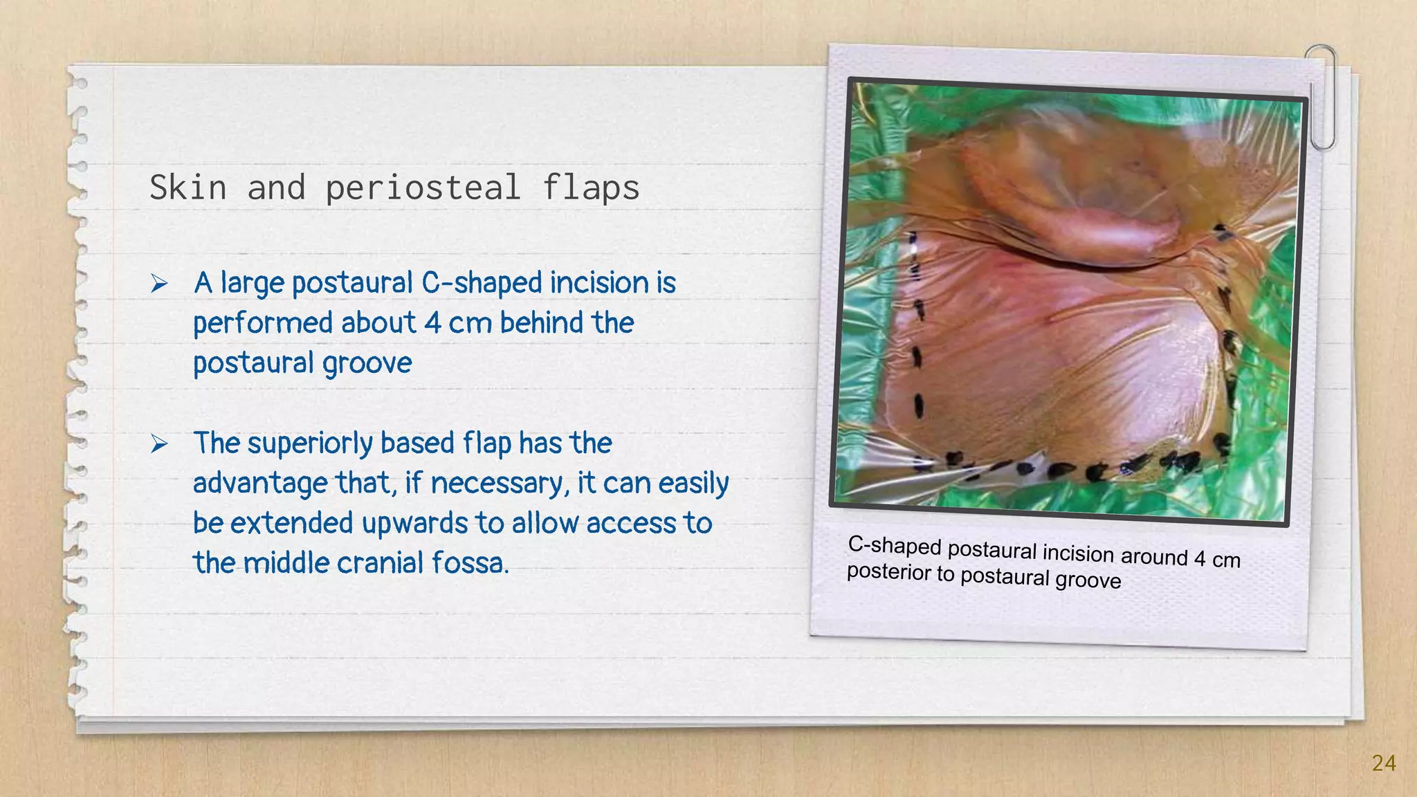 Vestibular schwannoma (acoustic neuroma) surgical anatomy and ...