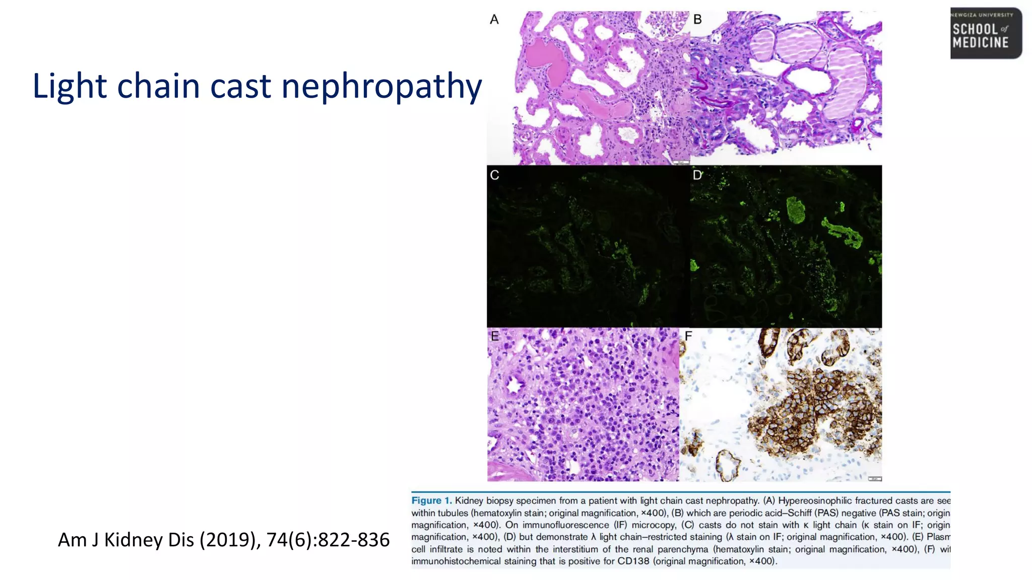 Dysproteinemias Related Renal Disorders, Monoclonal Gammopathy ...
