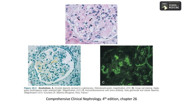 Dysproteinemias Related Renal Disorders, Monoclonal Gammopathy ...