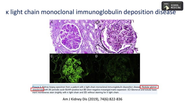 Dysproteinemias Related Renal Disorders, Monoclonal Gammopathy ...