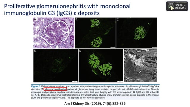 Dysproteinemias Related Renal Disorders, Monoclonal Gammopathy ...