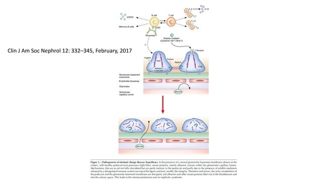 Adult Minimal Change Disease (KDIGO 2021 Guidelines) | PDF