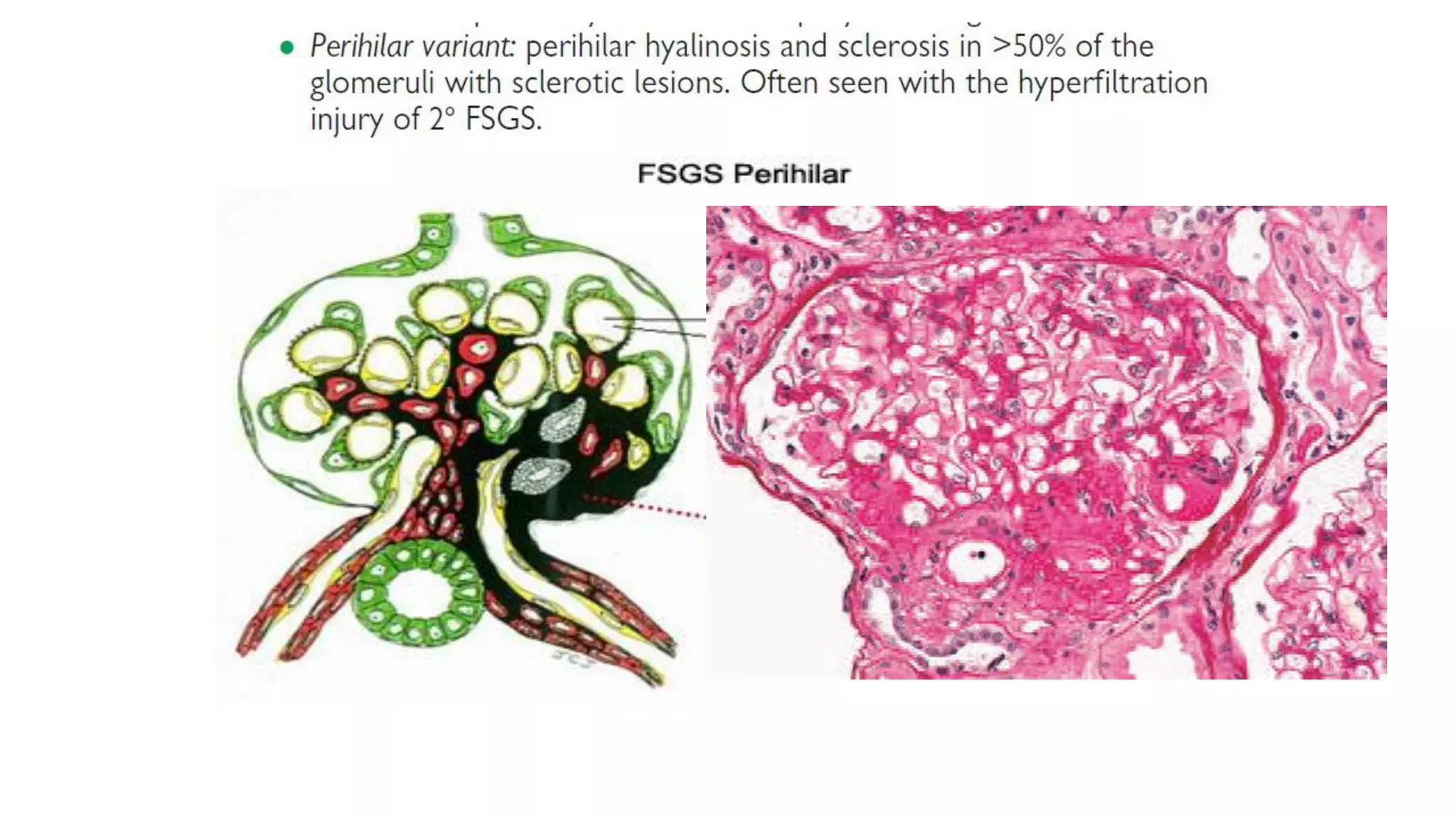 Focal Segmental Glomerulosclerosis - FSGS (KDIGO 2021 Guidelines) - Dr ...