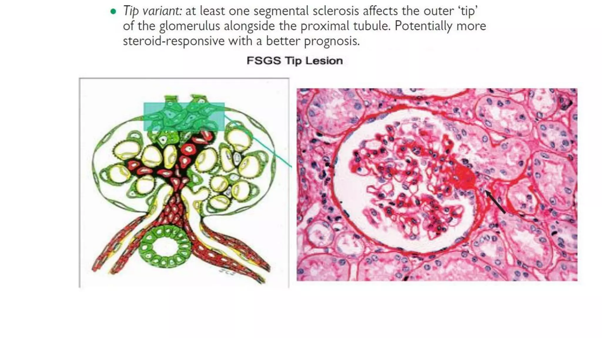 Focal Segmental Glomerulosclerosis - FSGS (KDIGO 2021 Guidelines) - Dr ...