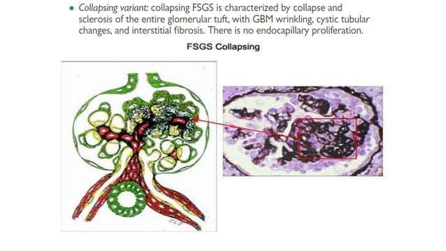 Focal Segmental Glomerulosclerosis - FSGS (KDIGO 2021 Guidelines) - Dr ...