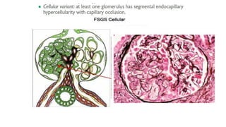 Focal Segmental Glomerulosclerosis - FSGS (KDIGO 2021 Guidelines) - Dr ...