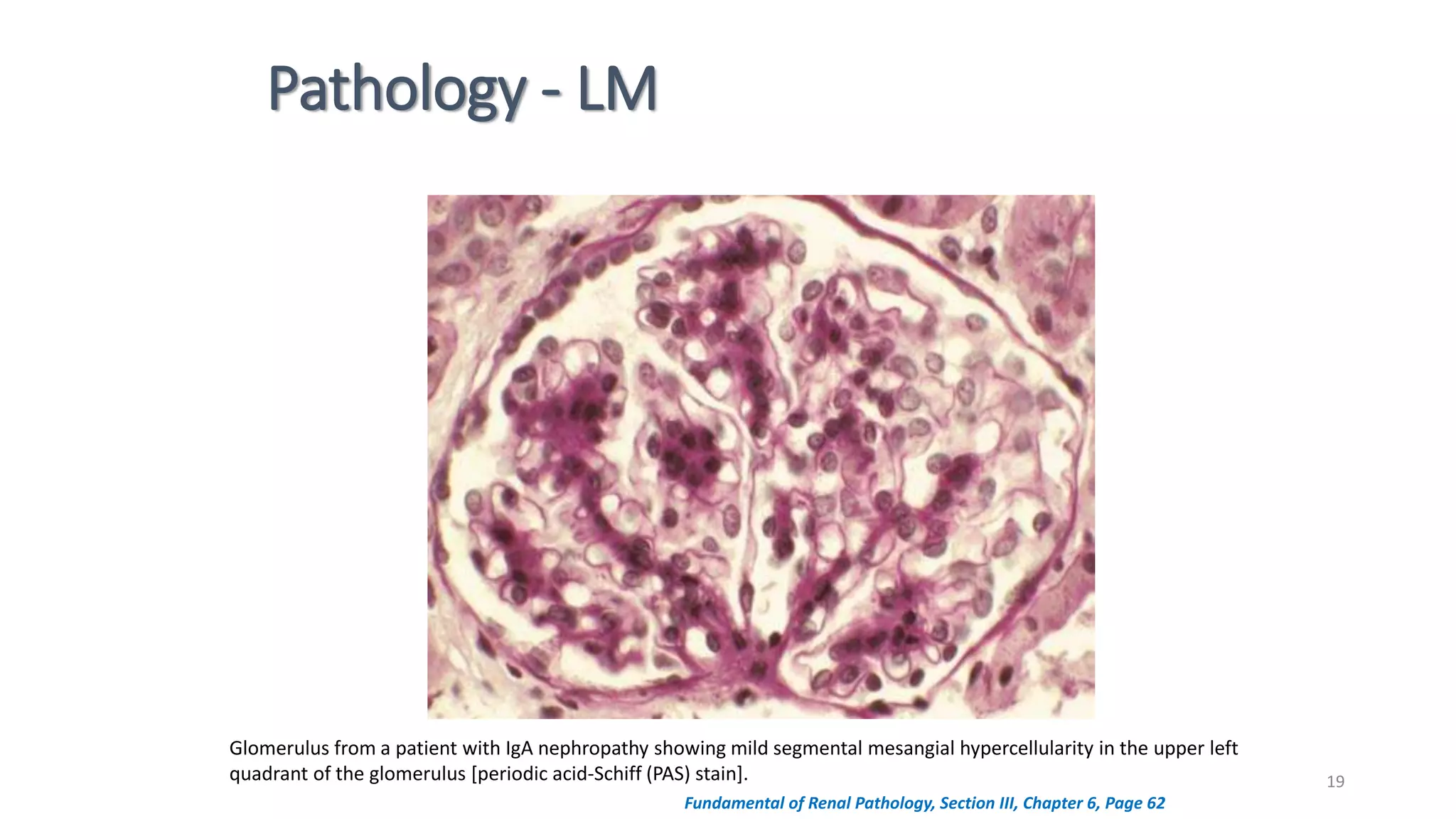 IgA Nephropathy (KDIGO 2021 Guidelines) - Dr. Gawad | PPTX IgA Nephropathy (KDIGO 2021 Guidelines) - Dr. Gawad | PPTX