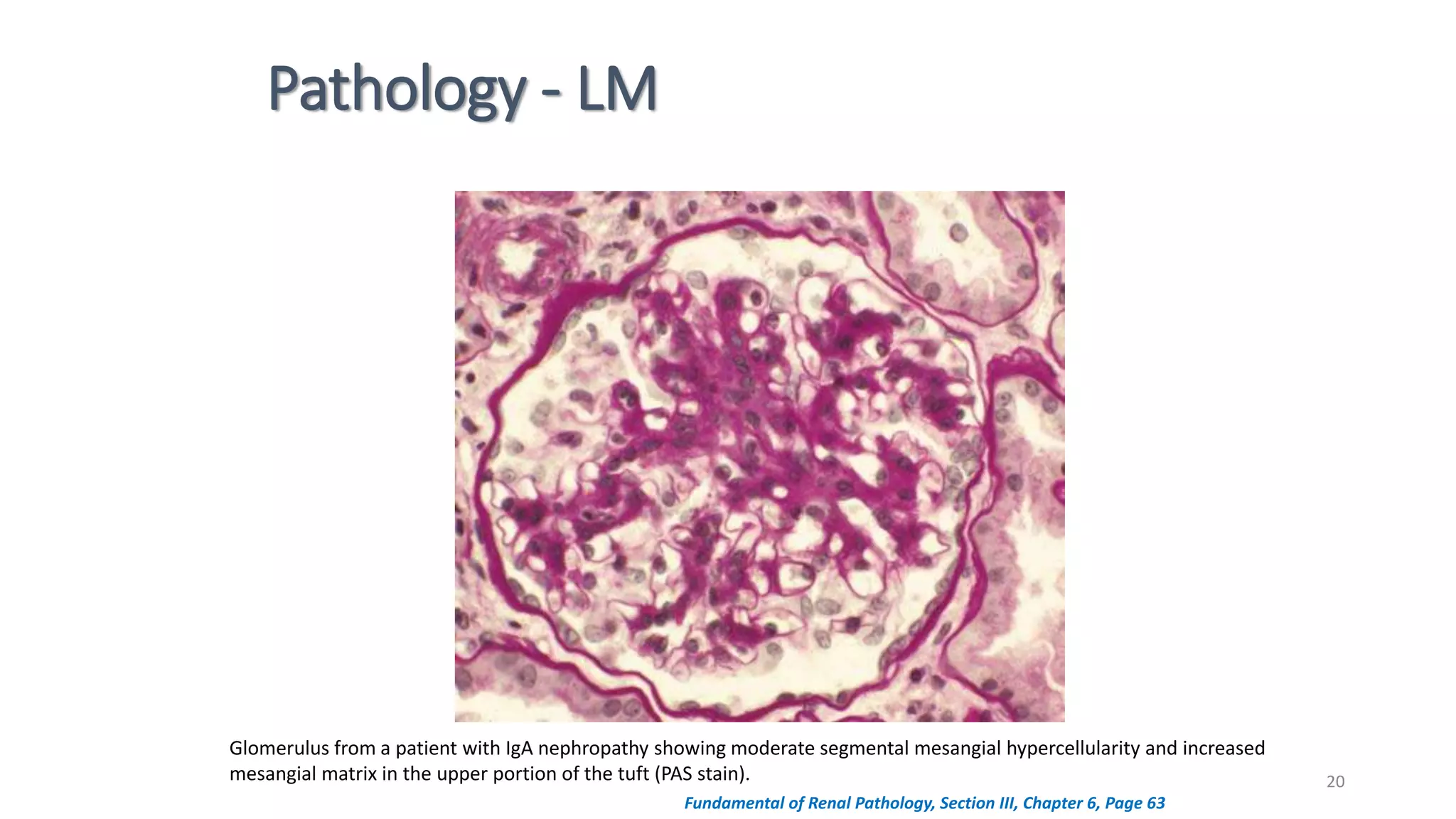 IgA Nephropathy (KDIGO 2021 Guidelines) - Dr. Gawad | PPTX IgA Nephropathy (KDIGO 2021 Guidelines) - Dr. Gawad | PPTX